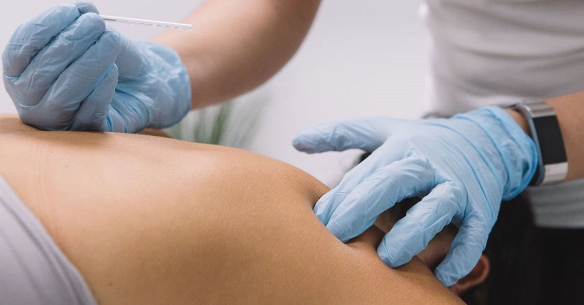How Dry Needling Can Help with Muscular Pain - Pure Physio